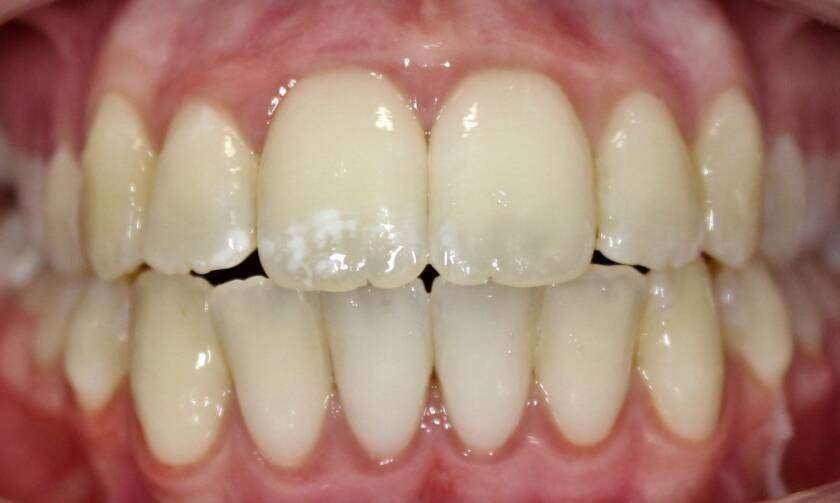 Metal Braces - Frederick Dental Clinic Dublin 1