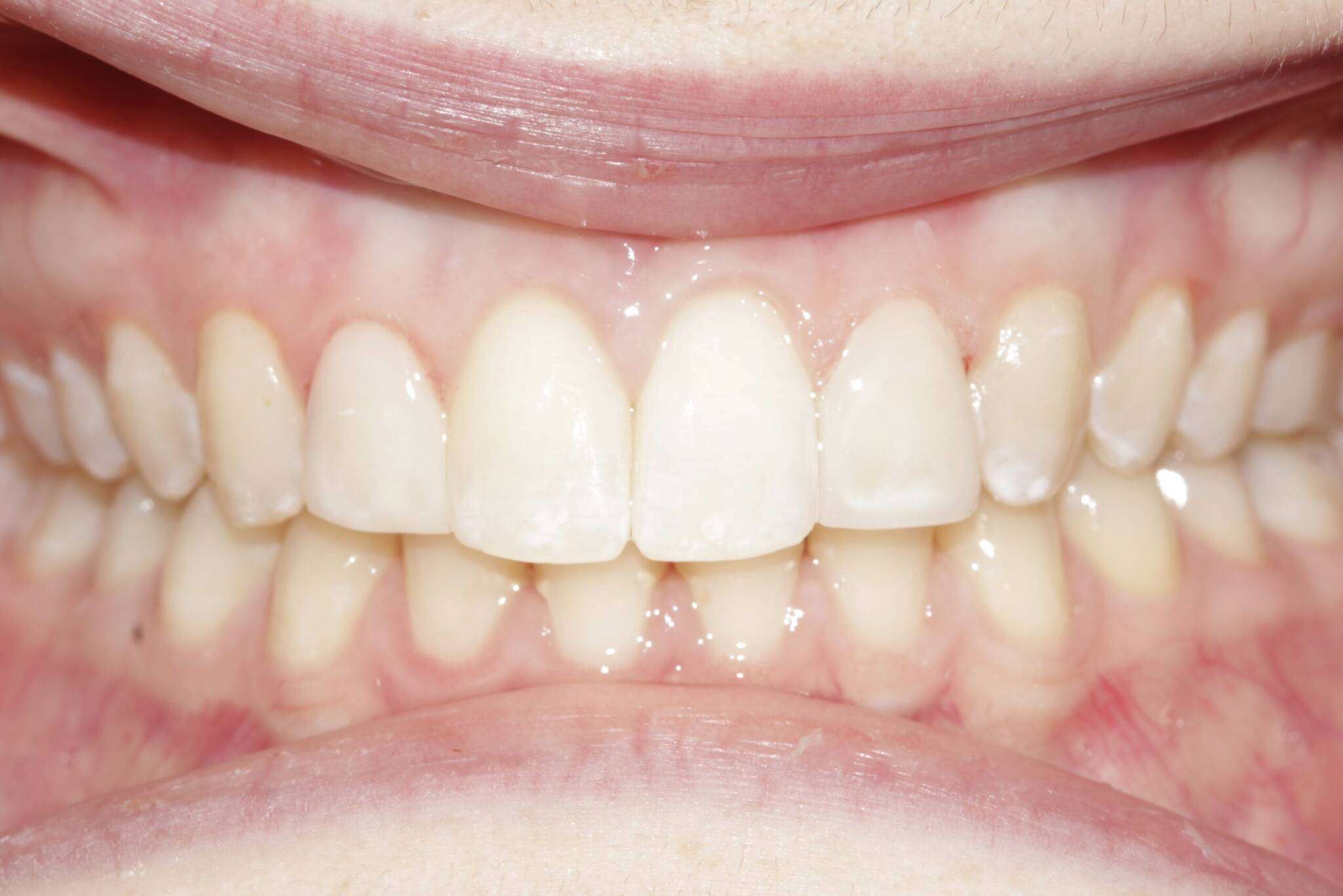 Invisible Aligners - Frederick Dental Clinic Dublin 1