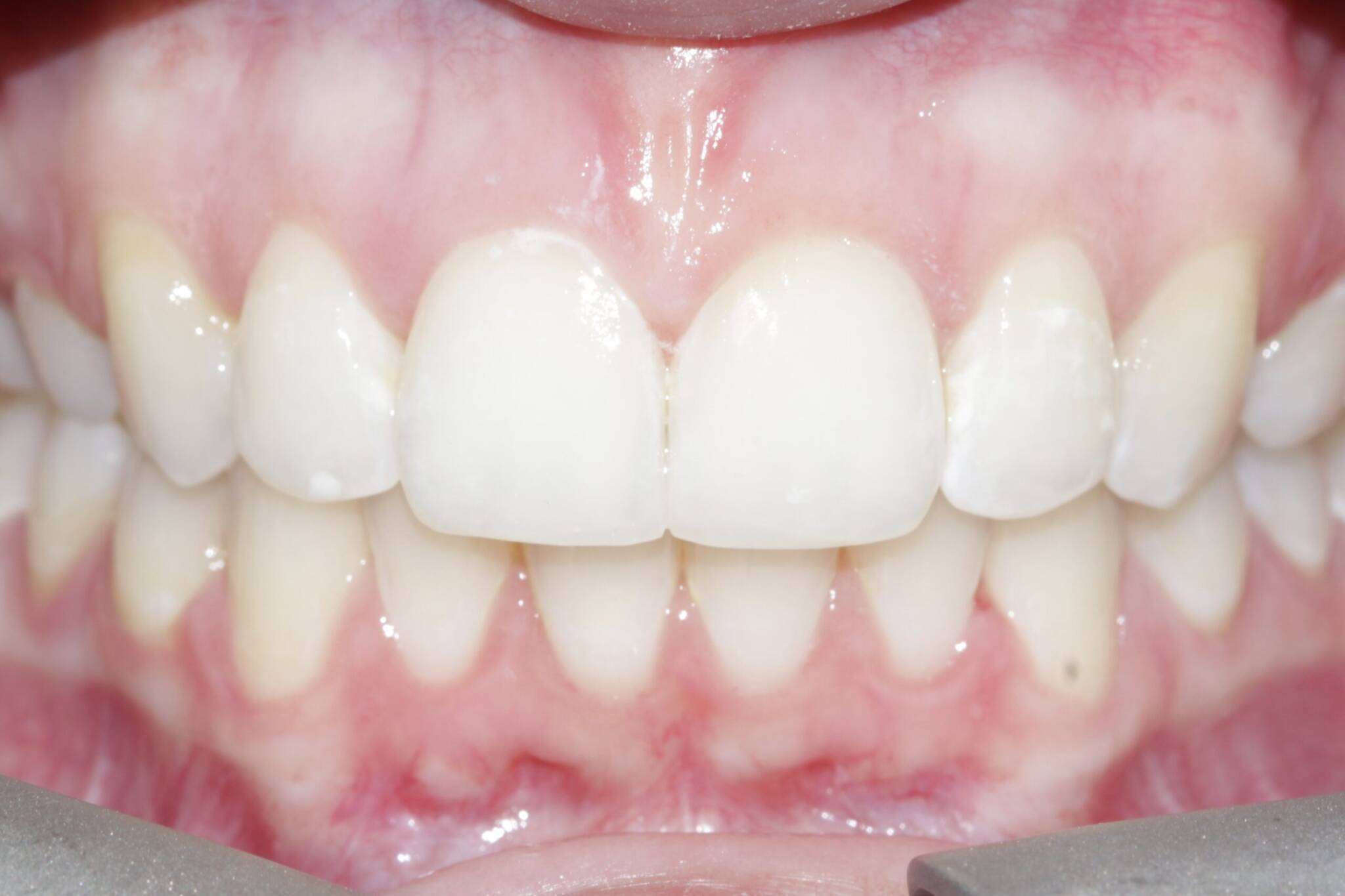 Clear Braces - Frederick Dental Clinic Dublin 1